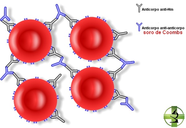 Esferocitose Adquirida | Biomedicina Padrão